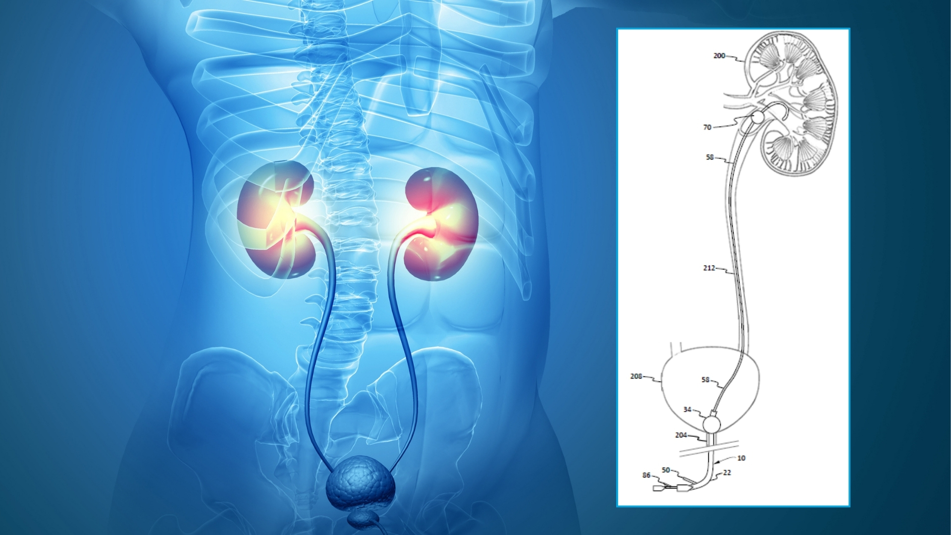Doctors Design a Simple Solution to Drug Delivery Dilemma - Polsky ...